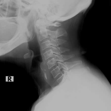 Thyroid Cartilage X Ray