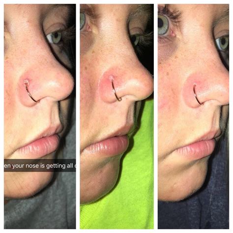 Healing Process With A Cartilage Piercing Bump Using Tea Tree Oil