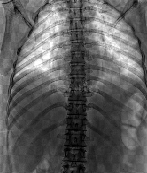 Professional Dorsal Spine Anterior Projection X Ray Isolated On A