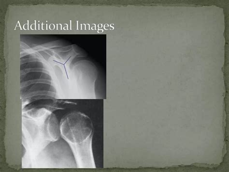 Posterior Shoulder Dislocation Pptx