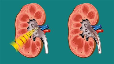 Litíase Ou Cálculo Renal Dr Marcelo Thiel