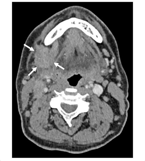 Ct Image Of Primary Submandibular Sdc Tumor Indicated By White