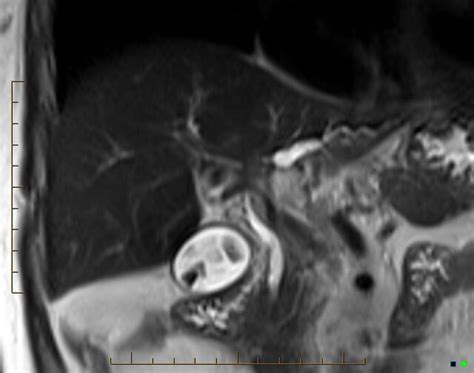 Radiopaedia Case Klatskin Tumor Hilar Cholangiocarcinoma Id 16963