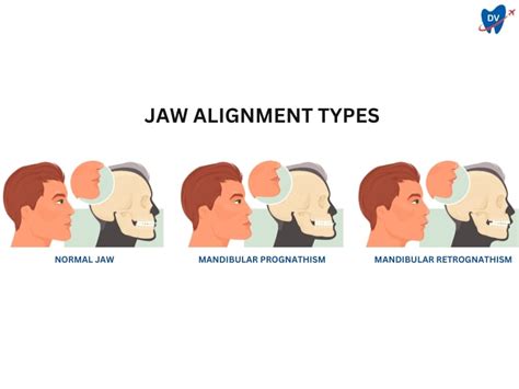 Jaw Alignment Types Orthognathic Surgery