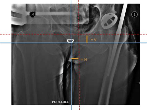 Variability Of Pelvic Orientation In The Lateral Decubitus Position