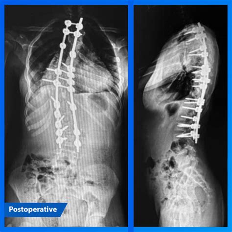 T2 L4 Thoracolumbar Fusion By Using Moss Vrs® Spinal System From