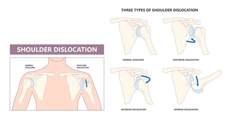 Dislocated Shoulder Best Treatment Options In 2025