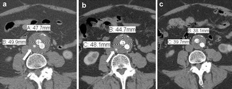 Type Ii Endoleaks Journal Of Vascular Surgery