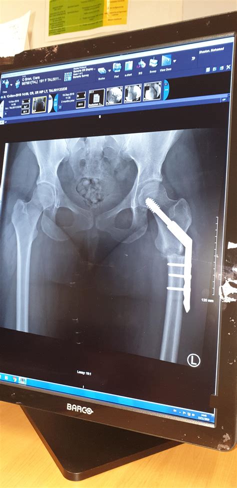 Derotational Osteotomy This Was My 6 Week Checkup I Had The Surgery