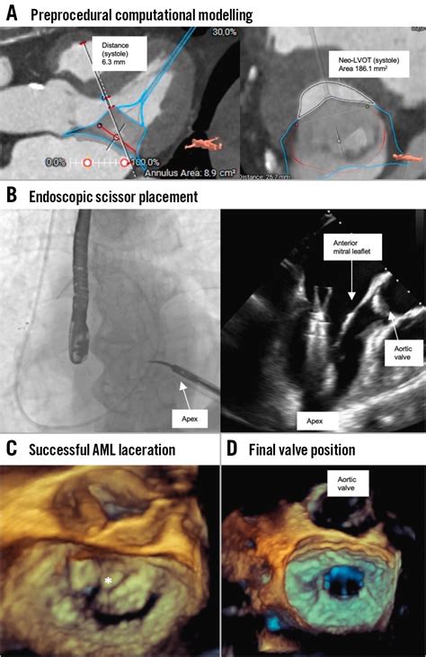 Anterior Mitral Leaflet Modification With Endoscopic Scissors During