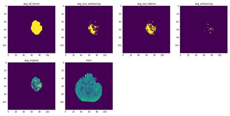 Github Ierolsen Brain Tumor Segmentation Brats 2019 This Repo Contains Brain Tumor