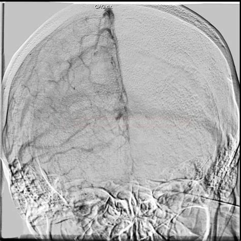 Vasculitis Stroke Manual