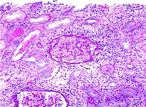 Renal Biopsy Showing Diffuse Expansion Of The Interstitium With