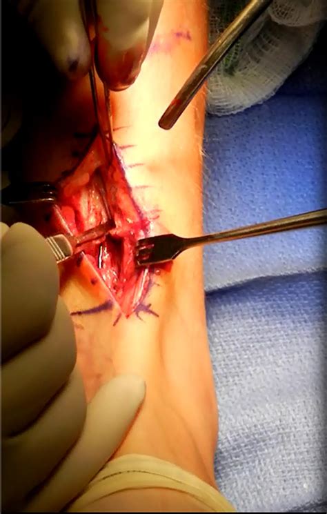 Tibia Anterior Approach Approaches Orthobullets