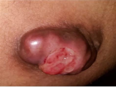 Leuco Sarcoma Cancer 4cm Tumor Removed From A 38 Year Old Mans Buttock