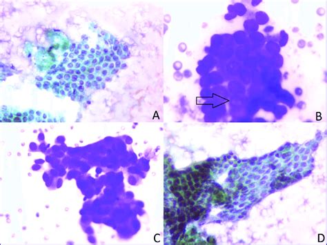 Case 2 Metastatic Papillary Thyroid Carcinoma In Cervical Lymph
