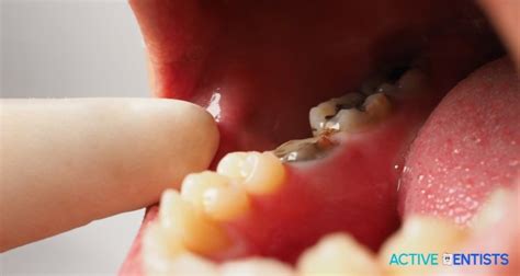 Common Dental Crown Problems And Solutions