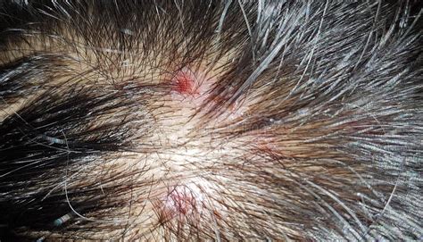 Scabs On The Scalp Wound On The Scalps Or Lichen Planus Follicularis Scabs On The Scalp Wound On The Scalps Or Lichen Planus Follicularis