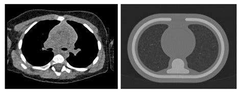 Paediatric Chest Phantom For Ct Keeping Infant Dose Alara Better Healthcare Technology Foundation