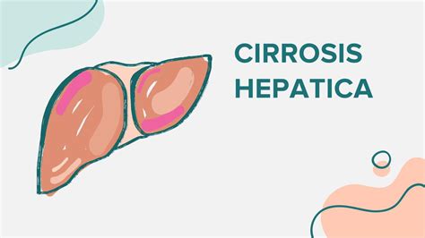 Cirrosis Hepatica Dr Habichuela Udocz