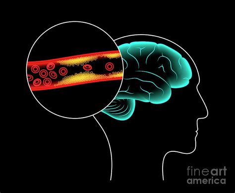 Ischaemic Stroke By Science Photo Library