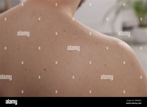 Closeup Of Mans Body With Birthmarks On Blurred Background Back View