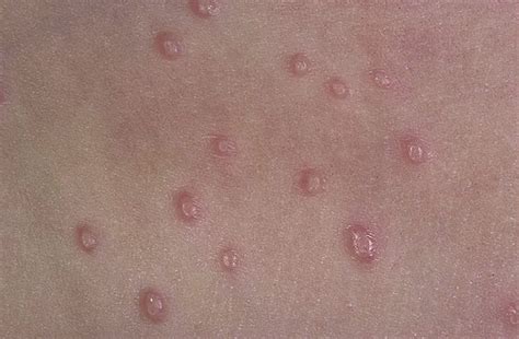 Контагиозный моллюск — причины появления симптомы и лечение — Паразиты и грибки в организме