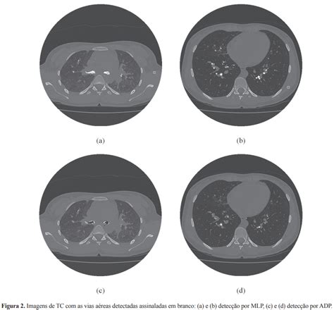 Segmentação Automática 2d De Vias Aéreas Em Imagens De Tomografia Computadorizada Do Tórax Nuven