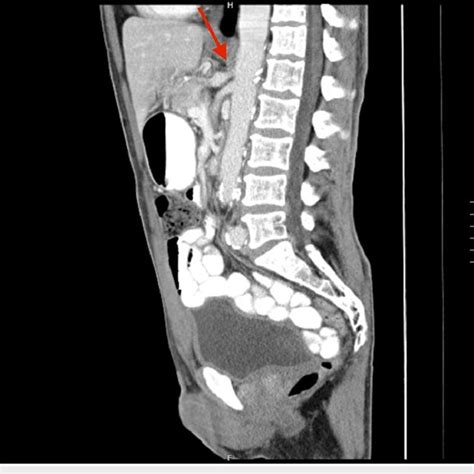 Preoperative Ct Of The Abdomenpelvis Demonstrating Celiac Artery