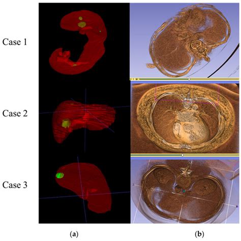 Three Dimensional Segmentation Of A Itk Snap And B 3d Slicer For