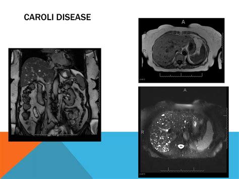 Quick Review Of Hepatobiliary And Pancreatic Lesion Pptx