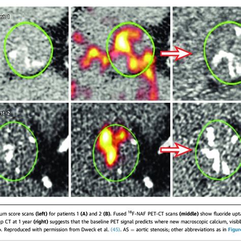 Myocardial Mass Quantification And Tissue Characterization By Cmr Download Scientific Diagram
