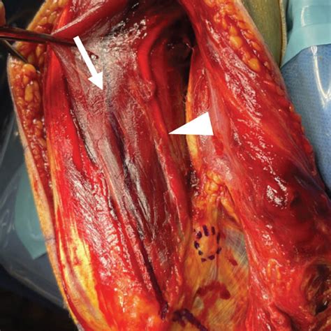 Unc Method In Practice Circled Area Is The Medial Epicondyle Of The