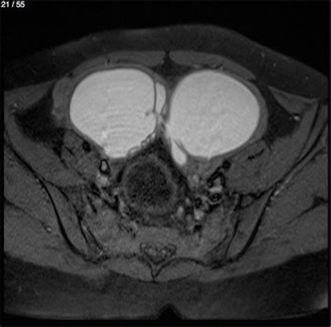 Dr Mohd Ilyas On Linkedin Endometriosis Gynecologicradiology Mri