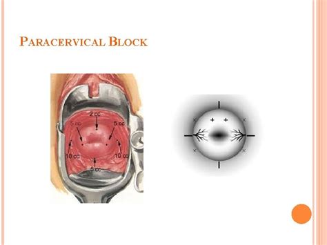 Pharmacologic Management Of Pain During Labor And Delivery