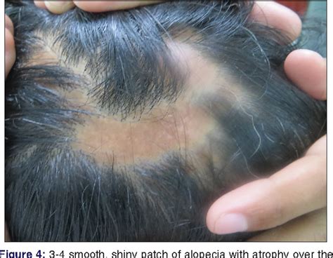 Figure 4 From Primary Idiopathic Pseudopelade Of Brocq Five Case Reports Semantic Scholar