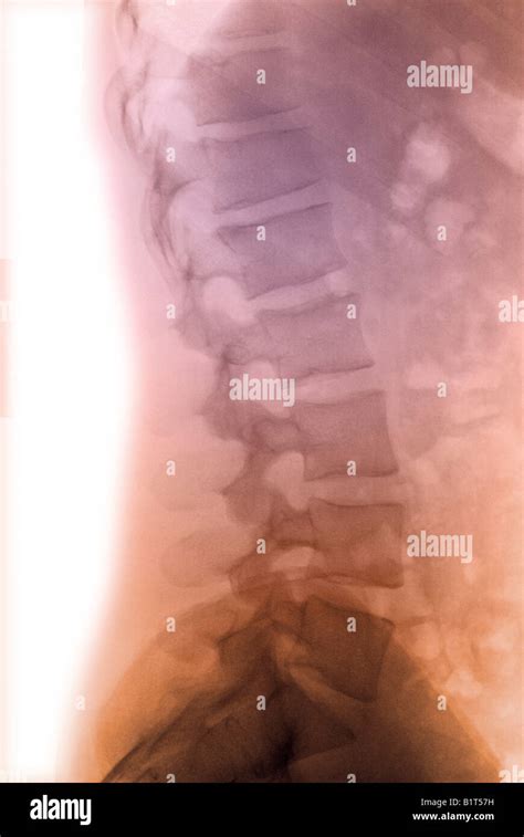 X Ray Normal Lumbar Spine Hi Res Stock Photography And Images Alamy