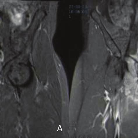 Initial Magnetic Resonance Imaging Showing A Lesion Involving The Right