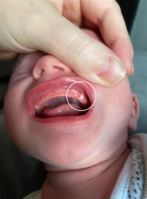 Epstein Pearls In Babies Causes Symptoms And Safe Treatment