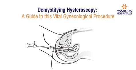 Understanding Hysteroscopy Procedure Steps And Recovery