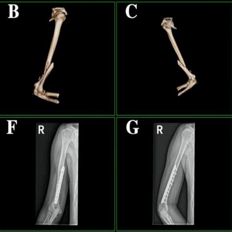 A 28 Year Old Male Patient Suffered A Fracture Of The Middle And Distal Download Scientific