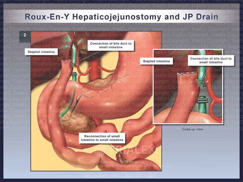 Roux En Y Hepaticojejunostomy
