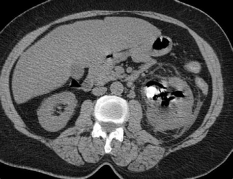 Emphysematous Pyelonephritis Review