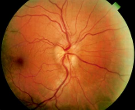 Small Optic Nerve