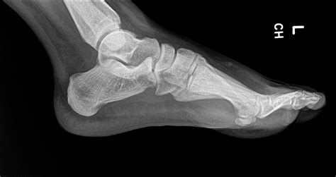 Orthodx Tarsal Navicular Fracture Clinical Advisor