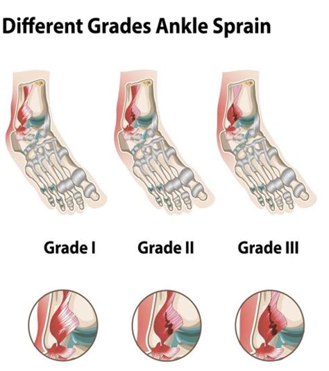 Sprained Your Ankle