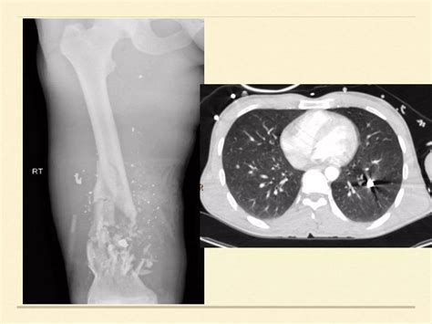 Cxr 1 Pptx