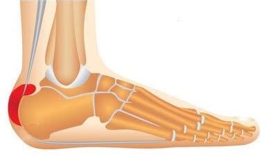 Pedal Piezogenic Papules Causes Symptoms And Treatment