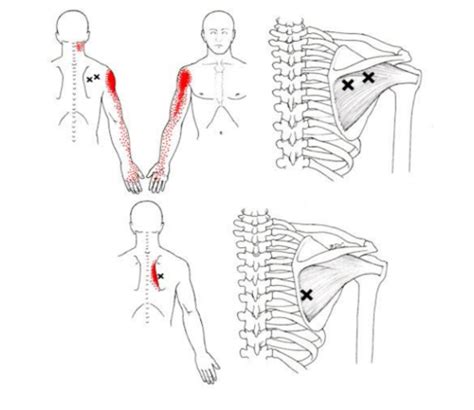 Trigger Points For Shoulder Px Flashcards Quizlet
