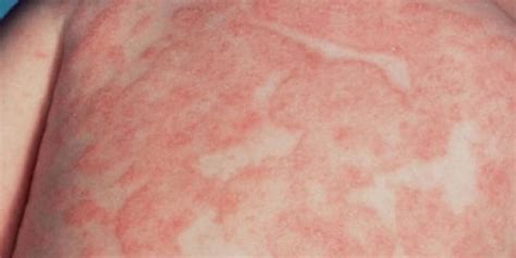 Photodermatosis Definition Of Photodermatosis